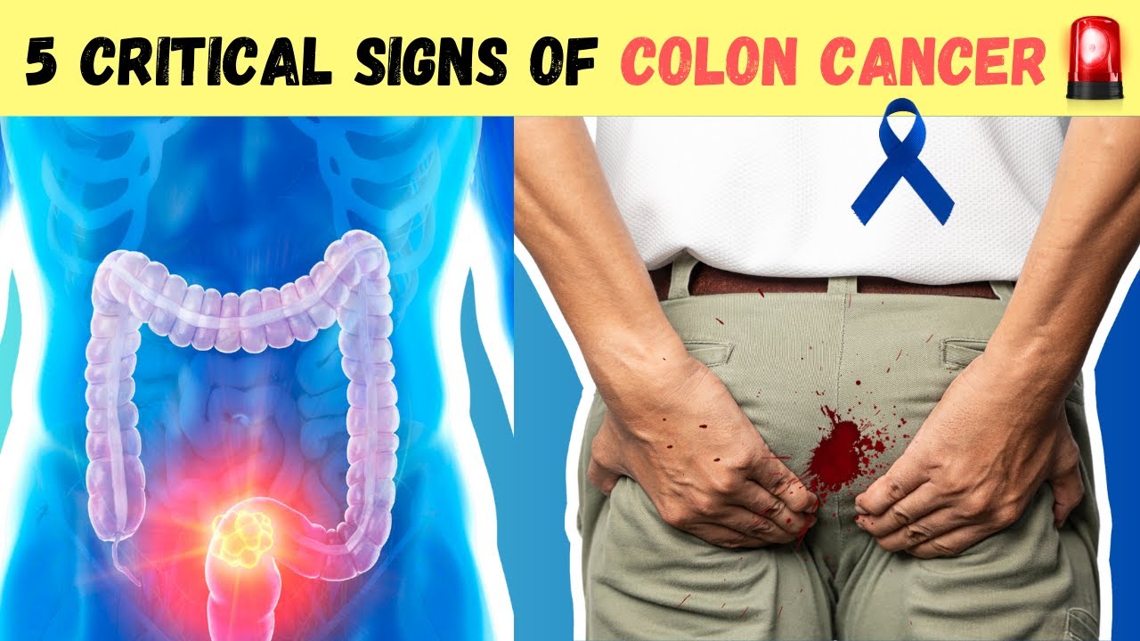 🚨5 Warning Signs of Colon Cancer You Can't Afford to Ignore!🚨 | MUST ...