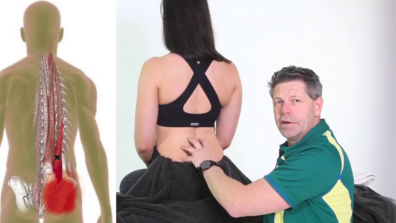 Erector Spinae Trigger Points