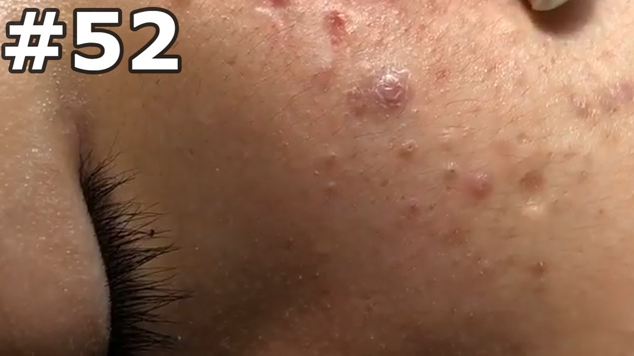 "🔴 Satisfying Pimple Popping Extravaganza! Watch the Most Satisfying ...