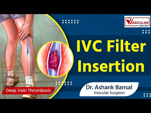 IVC Filter Insertion: Advanced Treatment for Deep Vein Thrombosis ...