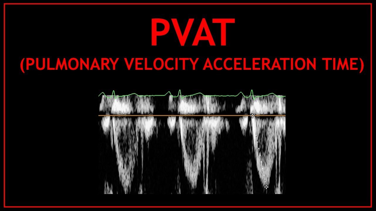Pulmonary Velocity Acceleration Time PVAT Echocardiography YouTube pulmonary-velocity-acceleration-time-pvat-echocardiography-youtube