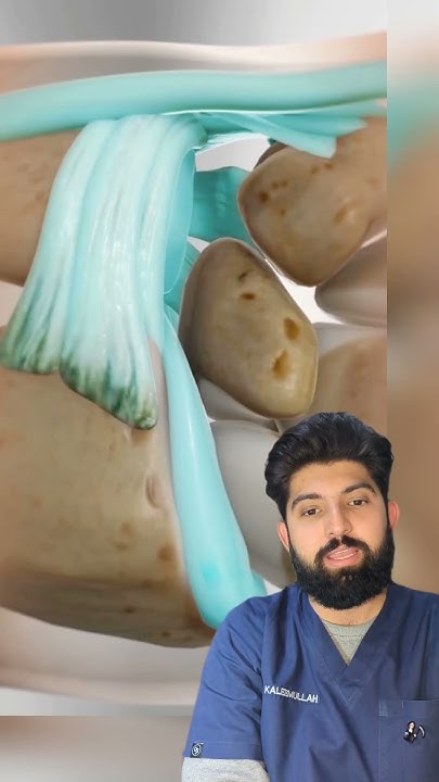 TFCC Tear Causes, Symptoms & Treatment | Wrist Pain Explained - YouTube