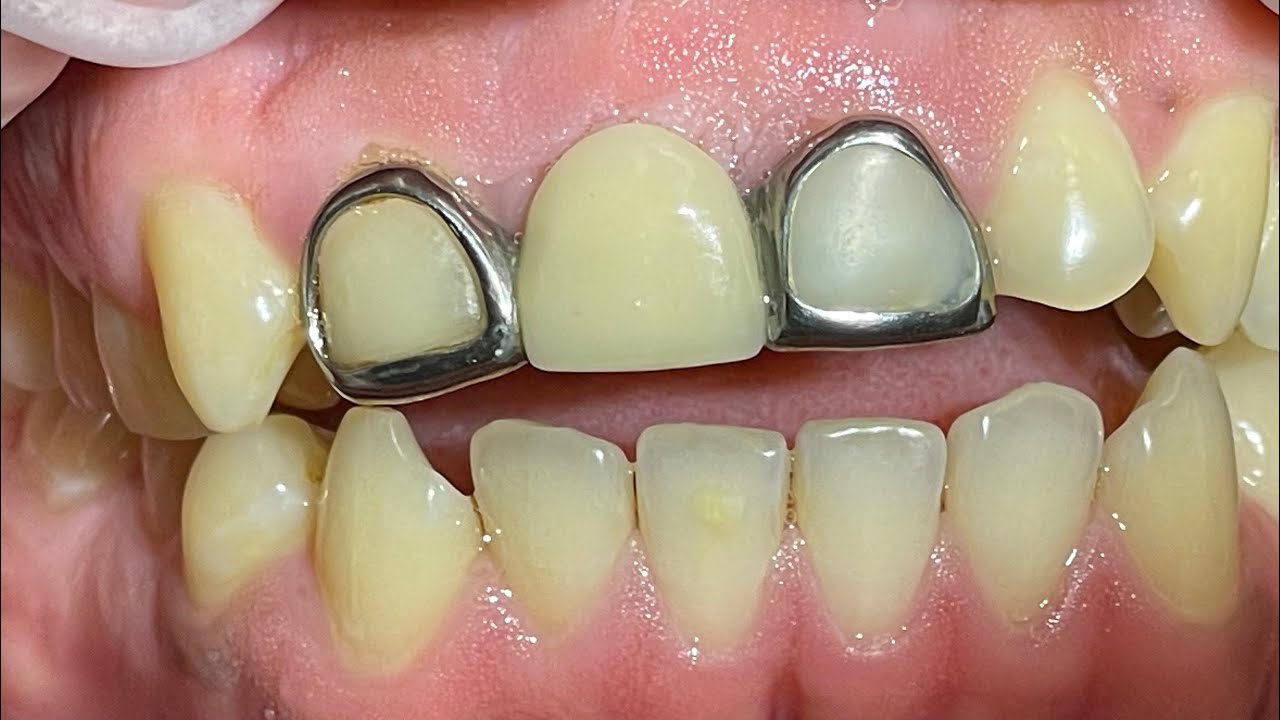 Replacing the Metal Window Crowns to Zirconia @GreatTeeth - YouTube