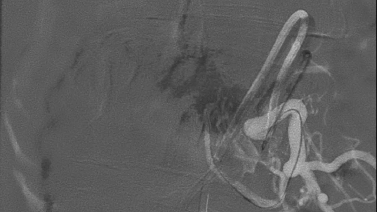 Transarterial Embolization of a Spinal Epidural Arteriovenous Fistula ...