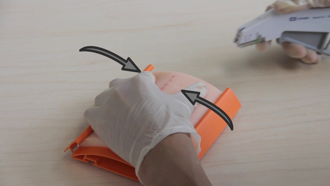 Staples Insertion and Removal - YouTube