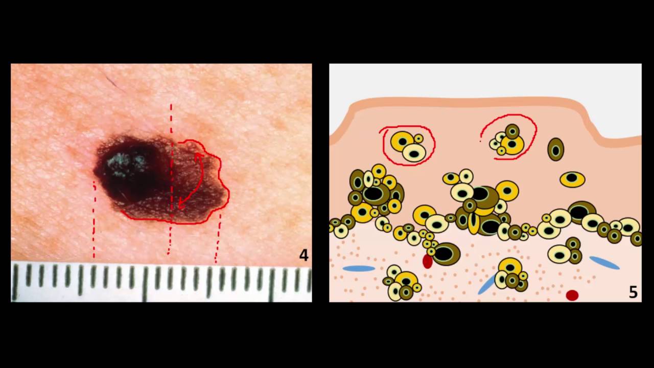 Introduction to Skin Cancer #4: The ABCDEs of Melanoma - YouTube