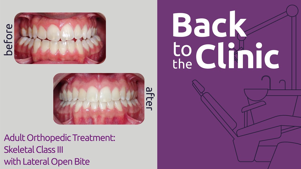 Adult Orthopedic Treatment: Skeletal Class III with Lateral Open Bite ...