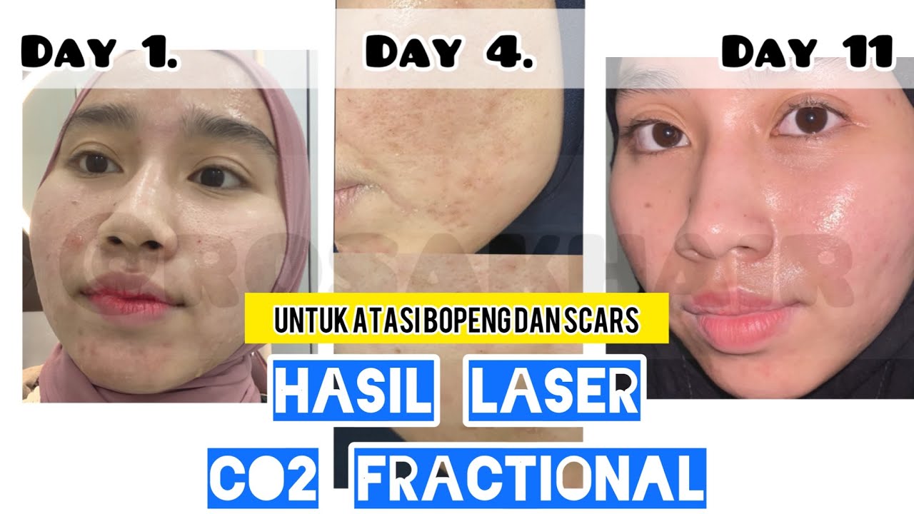 BEFORE AFTER LASER CO2 FRACTIONAL | UPDATE PROGRESS MENGURANGI BOPENG ...