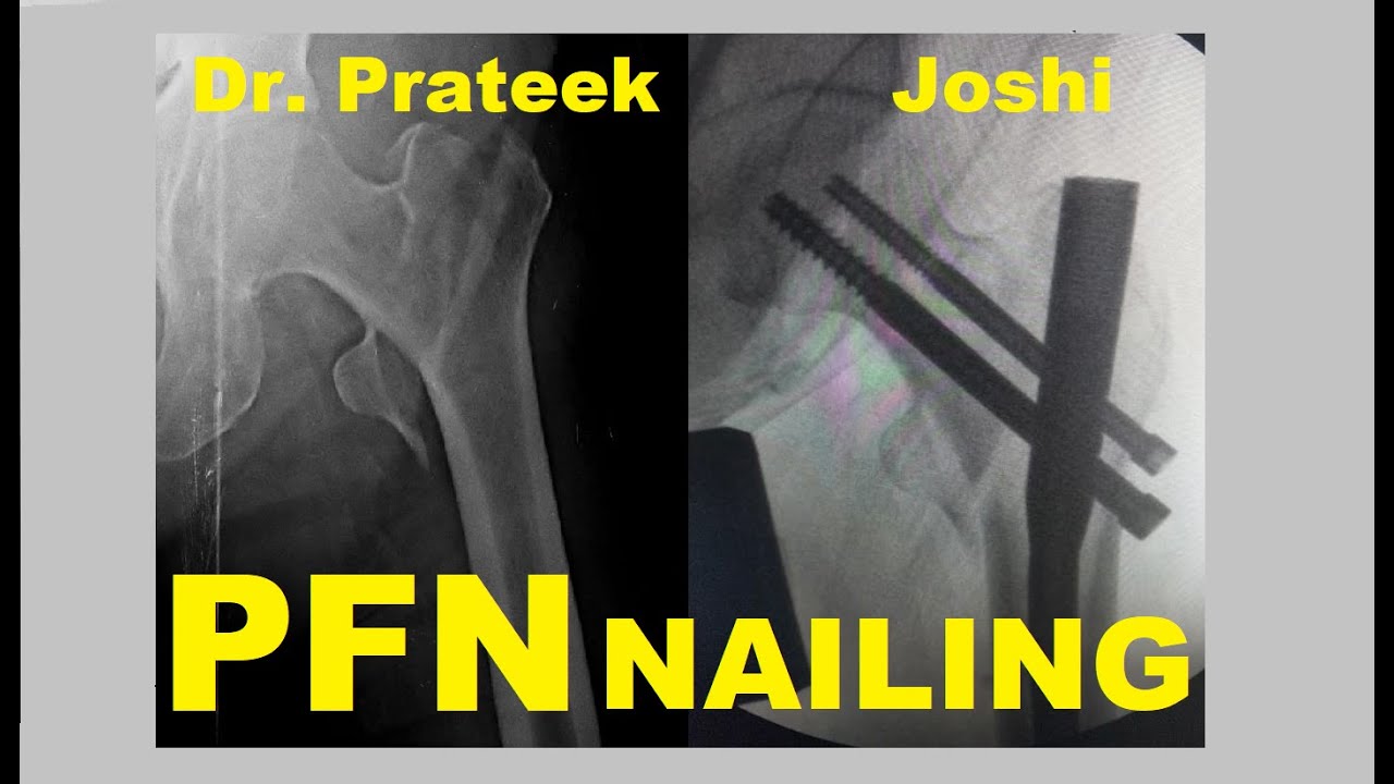 PFN NAILING | PROXIMAL FEMORAL NAILING | Intertrochanteric Fracture ...