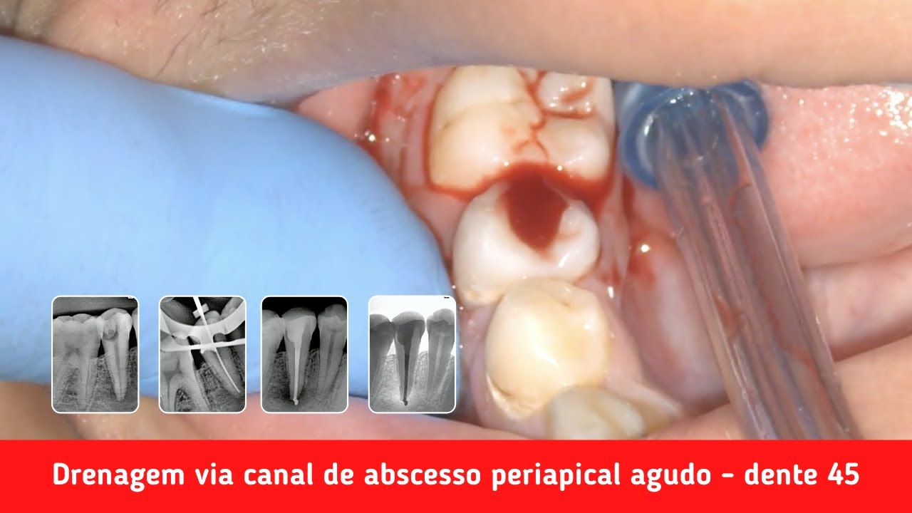 Demonstração de drenagem via canal de abscesso periapical agudo em ...