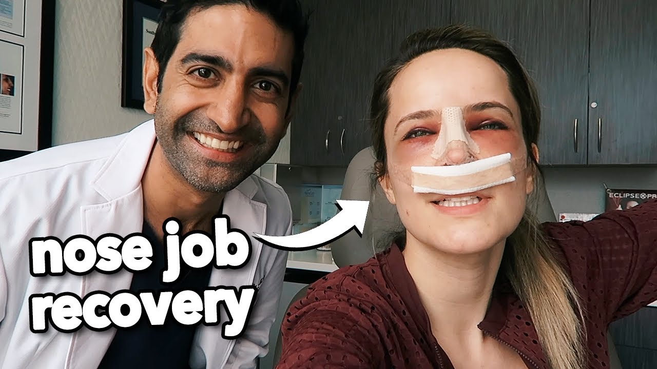 NOSE JOB VLOG: day 1-3 post op! looking scary... - YouTube