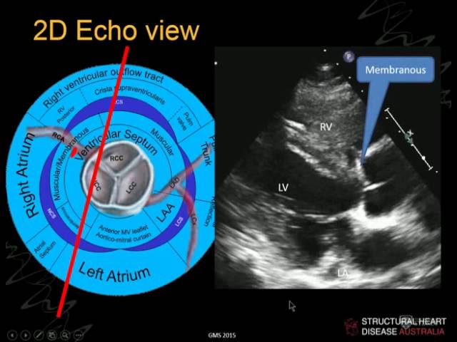 Aortic Valve Cusps Echo