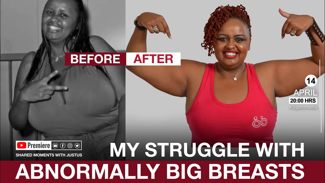 I Was Ridículed For My Abnormally Huge Breásts Gigantomastia Ruth