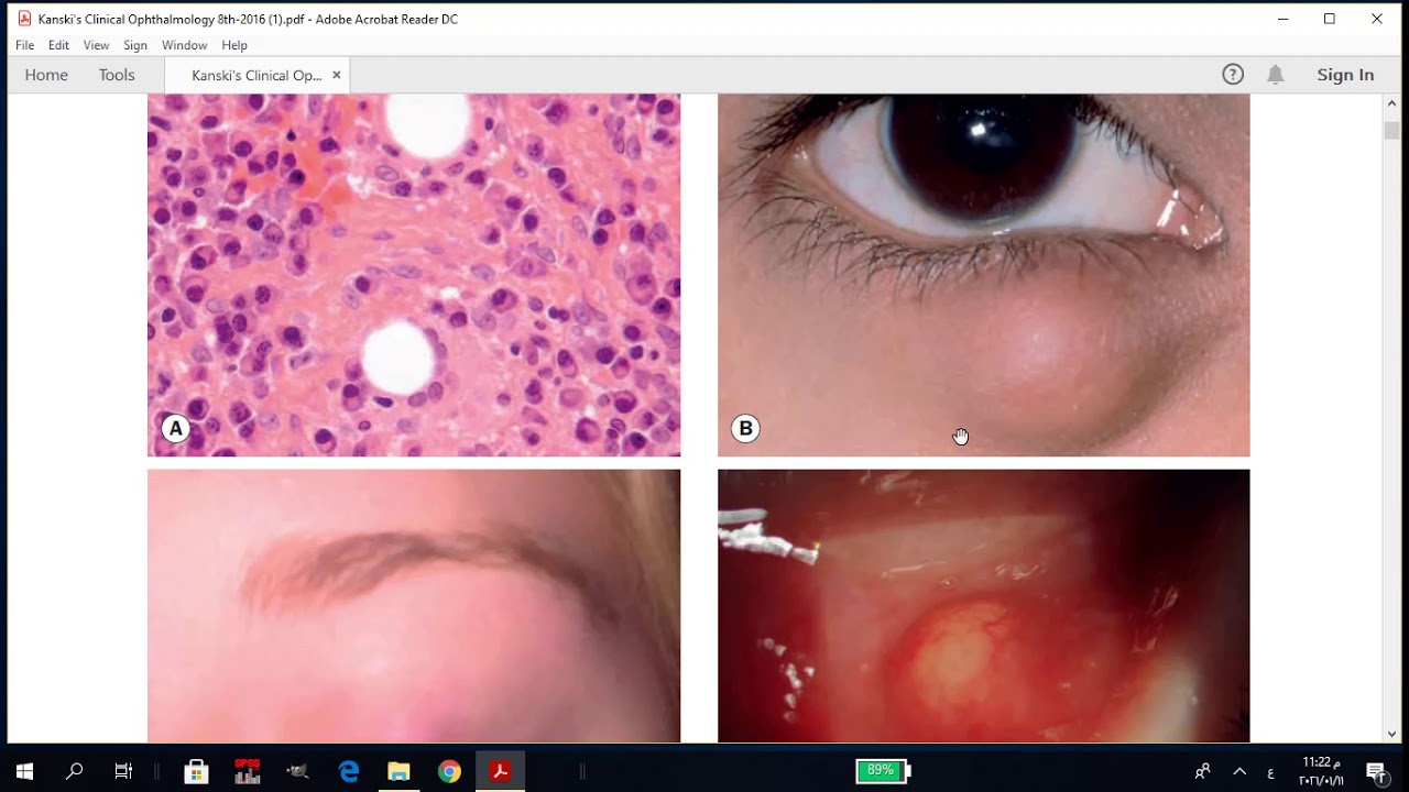 Kanski made easy - Lid 2 - YouTube