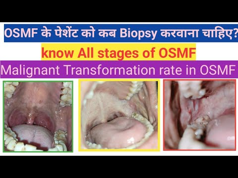Oral Submucous Fibrosis के पेशेंट को कब Biopsy करवाना चाहिए? When to go ...