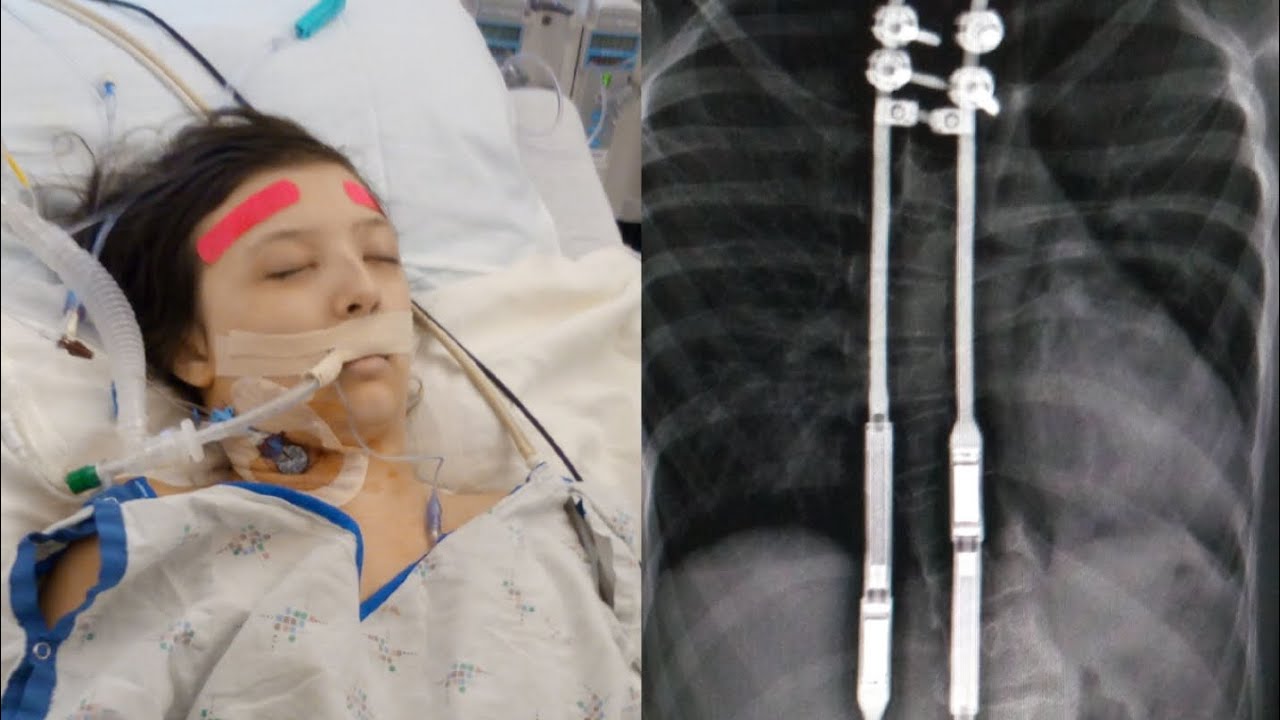 Rods Scoliosis Surgery at Philip Mayers blog