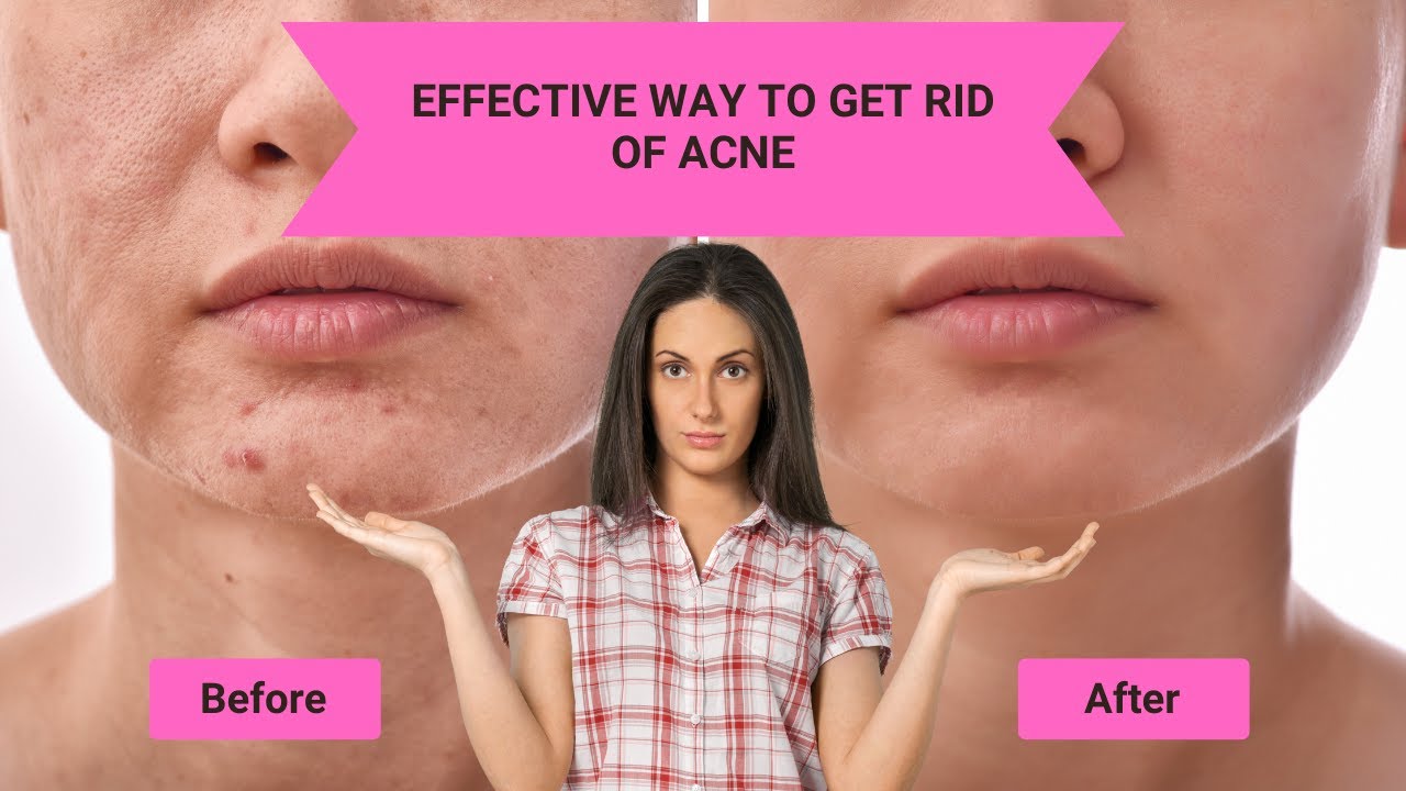 11 tips and tricks for acne| HOW TO MAINTAIN CLEAR SKIN WITHOUT ...