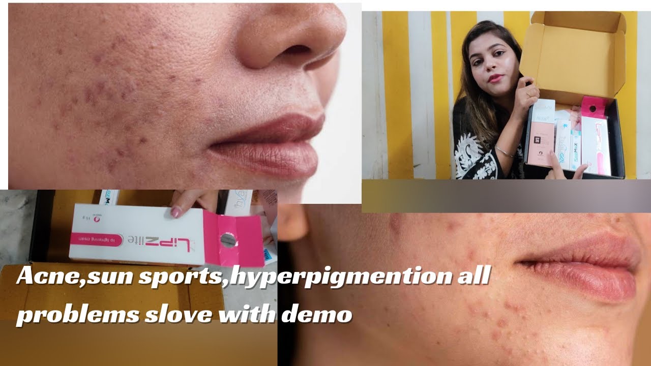 Hyperpigmentation, Sun sports,Acne,all,problems solution review & demo ...
