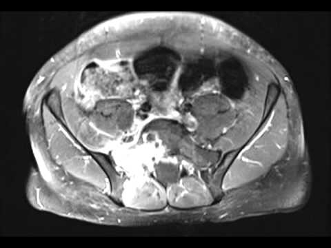 Your Sacrum CT Scan: What to Expect Before, During & After - Answermind ...