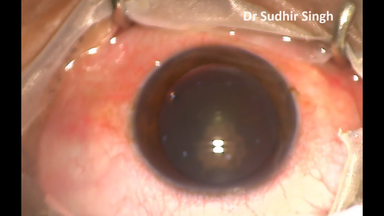 Phaco With Hydrophobic Foldable IOL In Very Soft Cataract HD Unedited ...