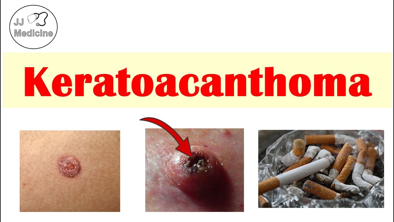Keratoacanthoma (Rapidly Growing Skin Lesion) | Risk Factors, Stages, Symptoms, Diagnosis ...