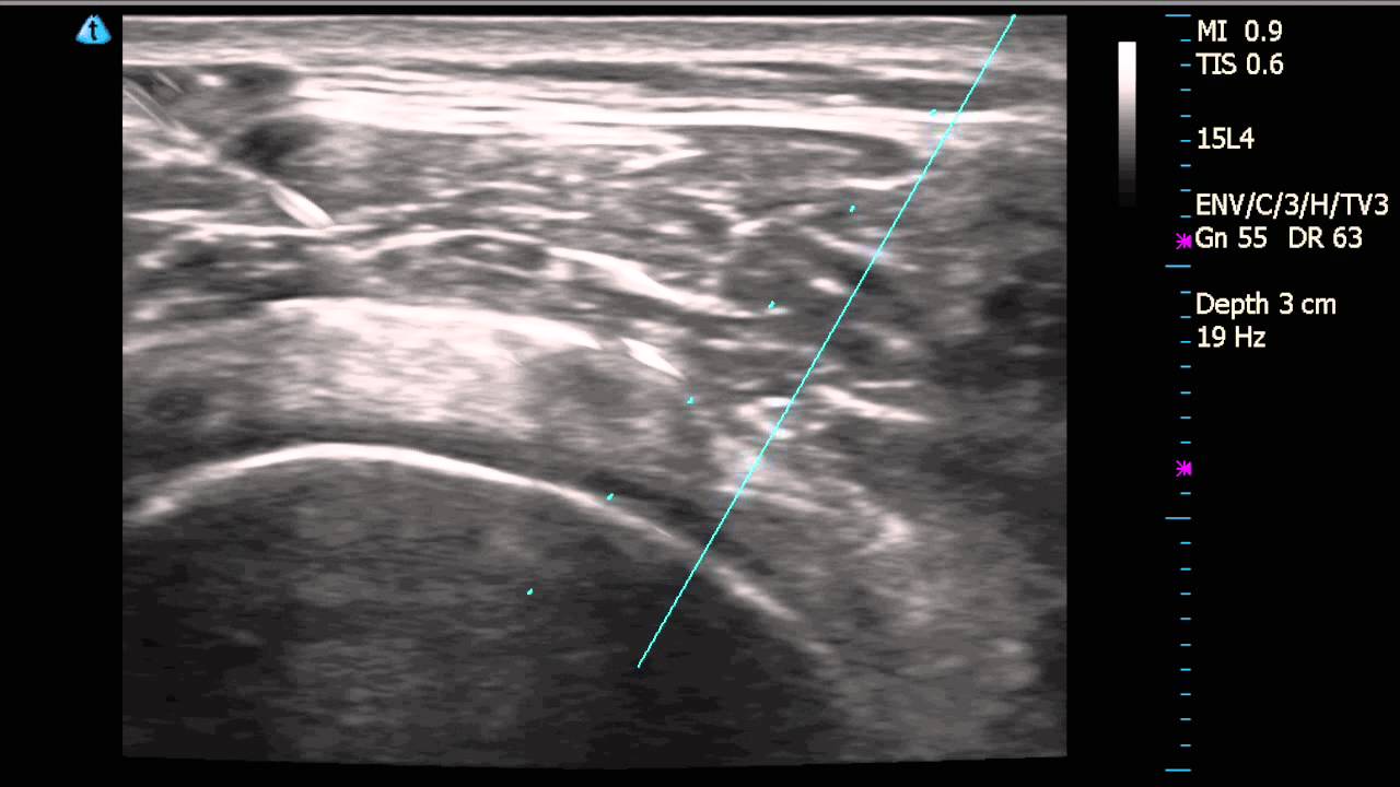 Right Shoulder Subacromial Bursitis Diagnosed By Ultrasound With Injection Youtube