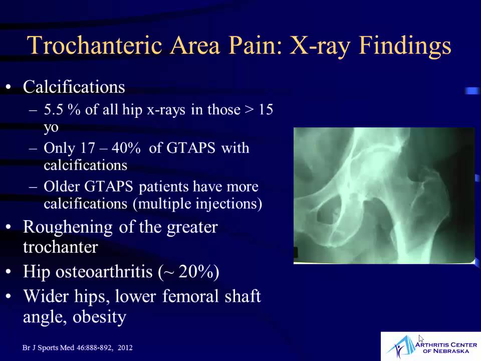 Dr. Robert Valente discusses greater trochanteric pain - YouTube