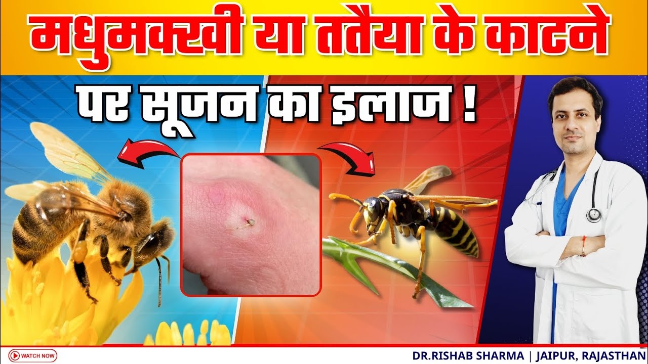 मधुमक्खी या ततैया के काटने पर सूजन का इलाज | Bee And Wasp Sting ...