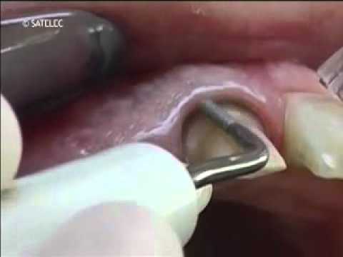 SATELEC® PERFECT MARGIN TIPS - YouTube