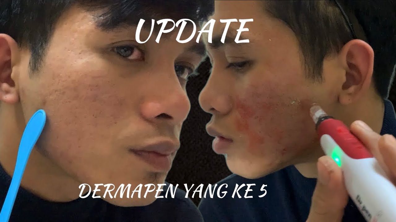 PPERAWATAN MENGHILANGKAN BOPENG BEKAS JERAWAT ACNE SCAR | DERMAPEN ...