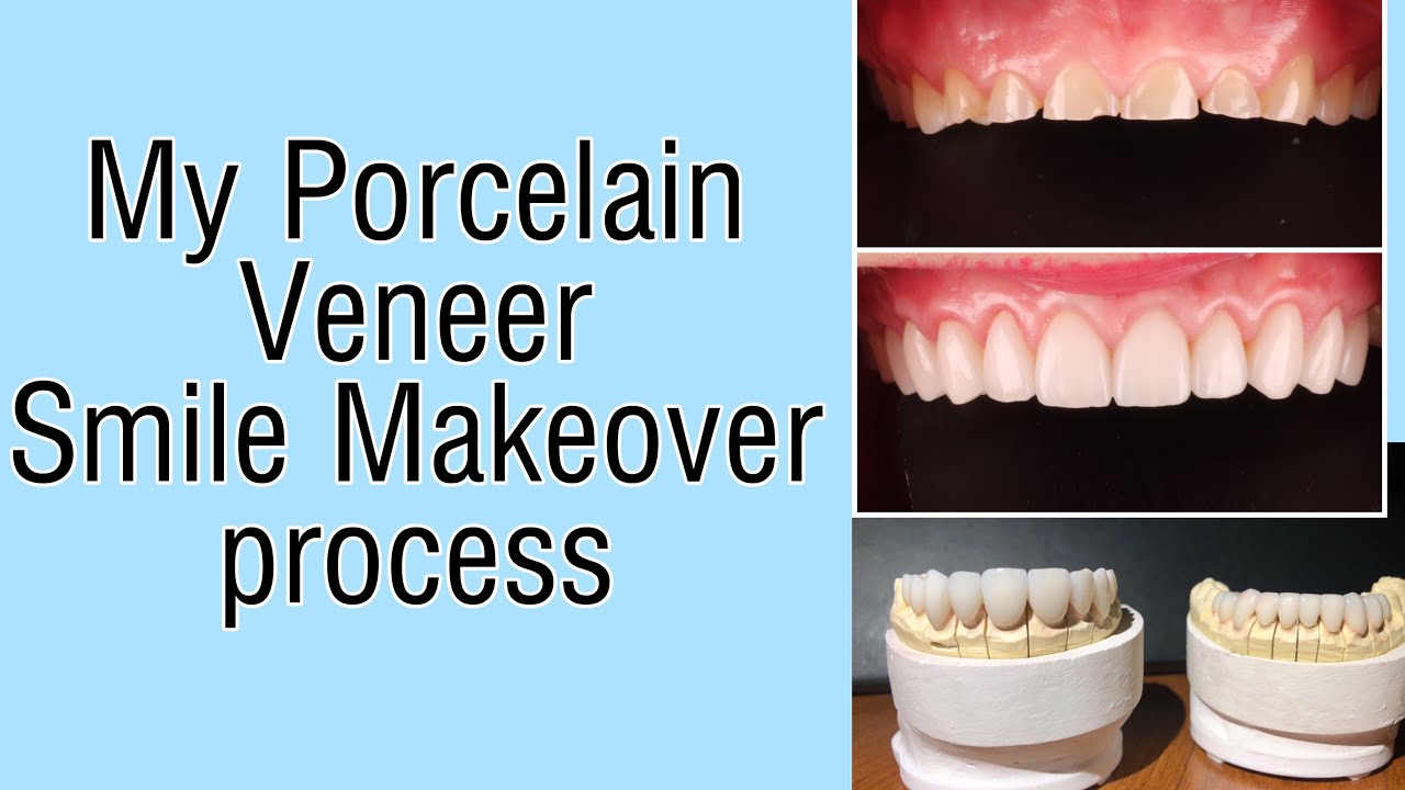 Dr. Hulse’s Porcelain Veneer Process at Austin Artistic Dental - YouTube