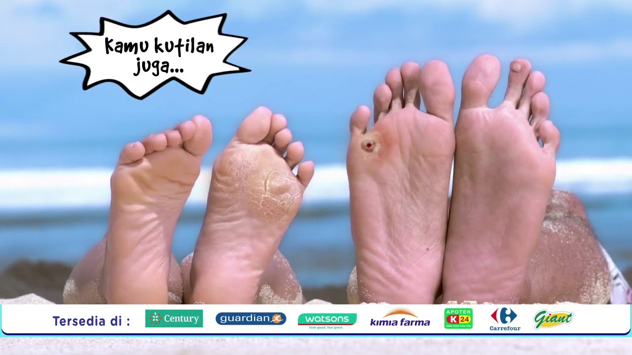 Callusol TVC Versi Panjang | Obat Kutil, Mata Ikan, Kapalan - YouTube