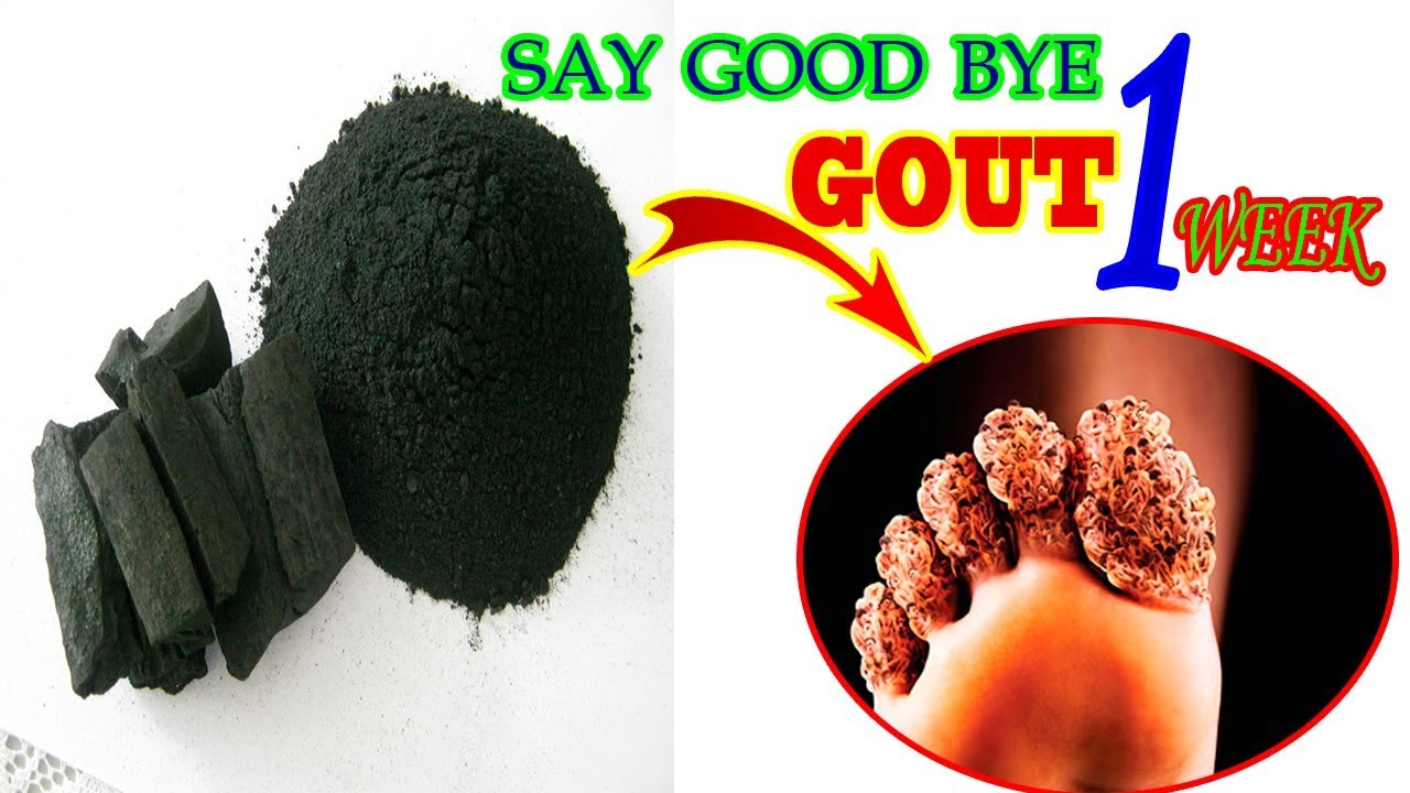 [GOUT TREATMENT] How To Cure Gout Fast At Home Only With Activated ...