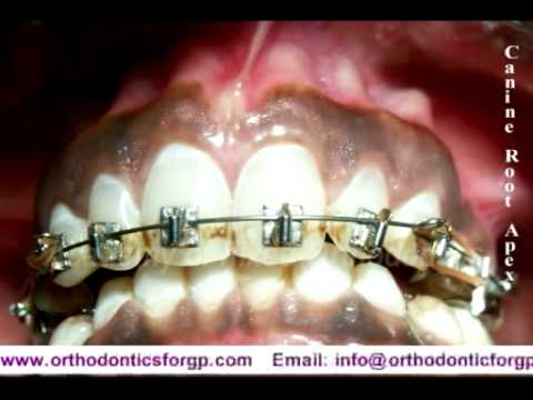 Beggs Light Wire Appliance in Orthodontics - YouTube