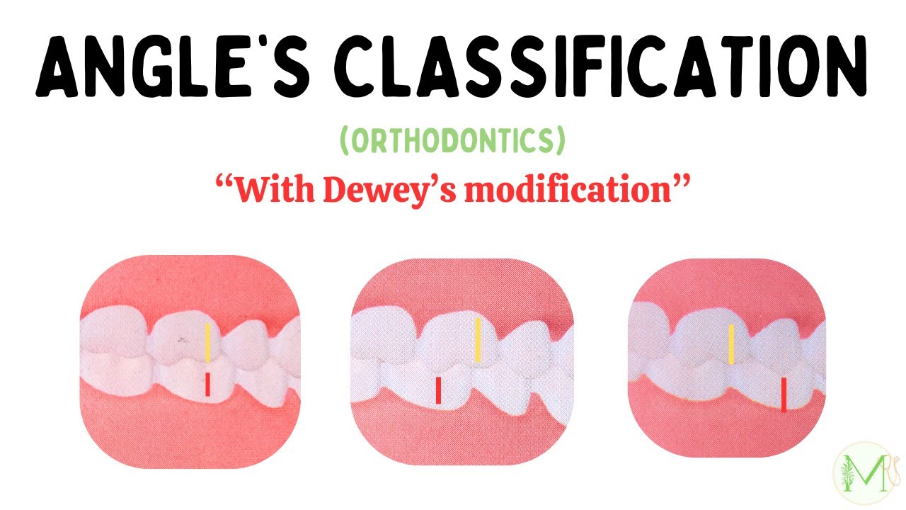 ANGLE’S CLASSIFICATION | Orthodontics | Medinare - YouTube