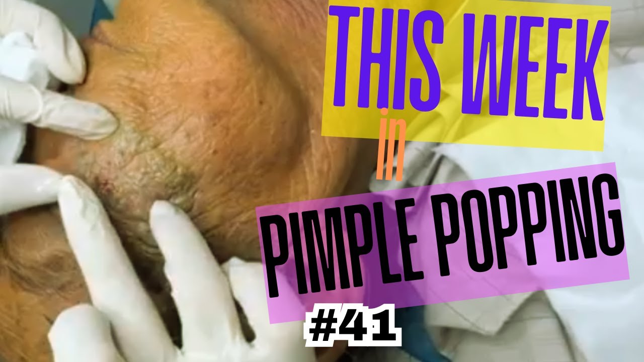 This Week in PIMPLE POPPING #41 - YouTube
