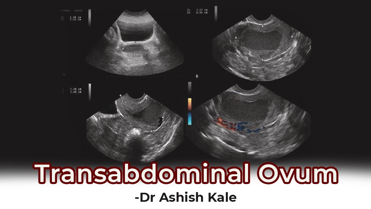 #transabdominal ovum pickup #Dr Ashish Kale - YouTube