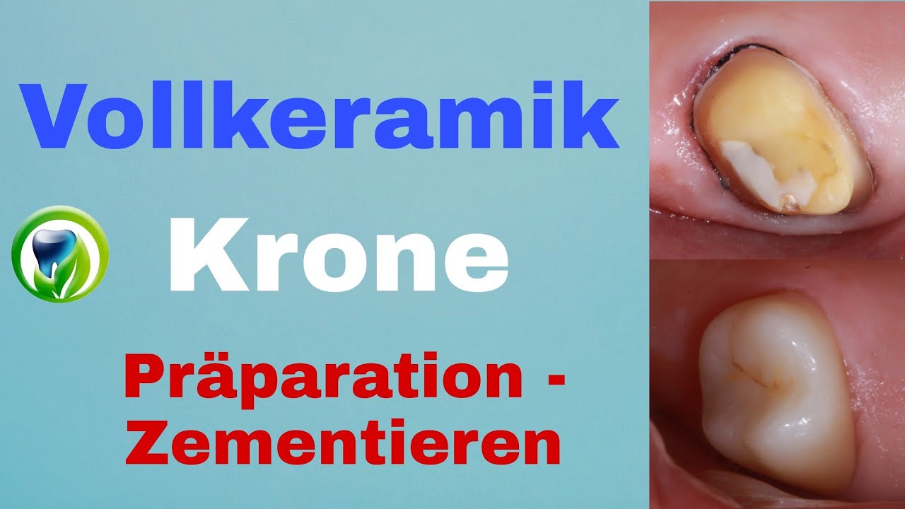 Vollkeramik-Krone im Seitenzahnbereich | Patientenfall, Präparation ...