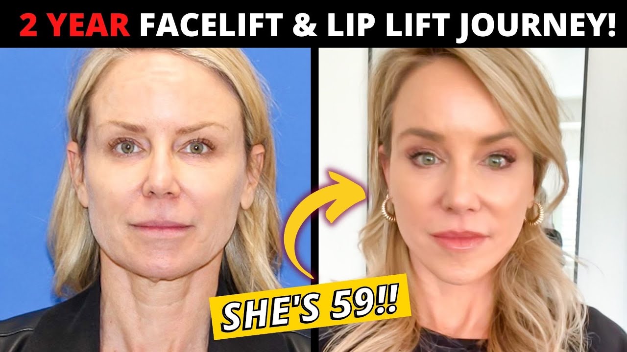 59 Year Old's 2 Year Facelift and Lip Lift Journey (her entire post-op ...