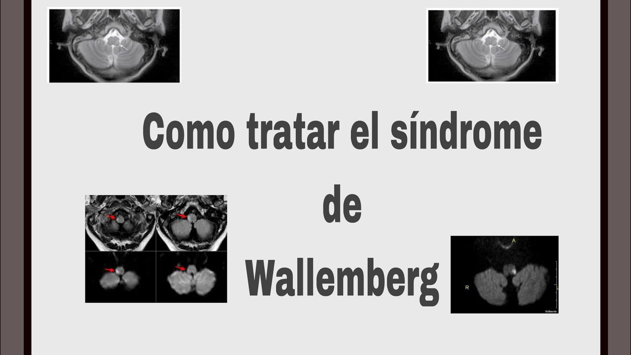 El Síndrome de Wallenberg , y su tratamiento , - YouTube