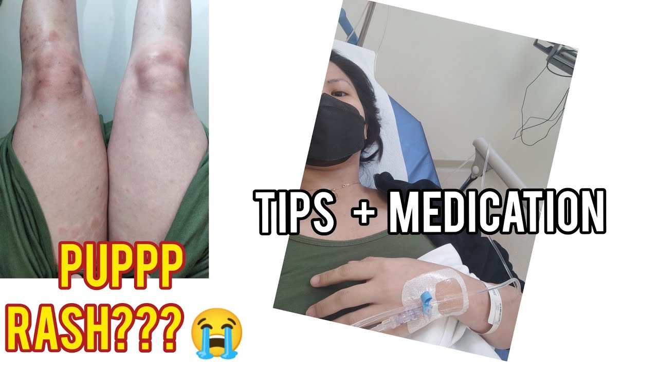 How to get rid of PUPPP RASH!!! - YouTube