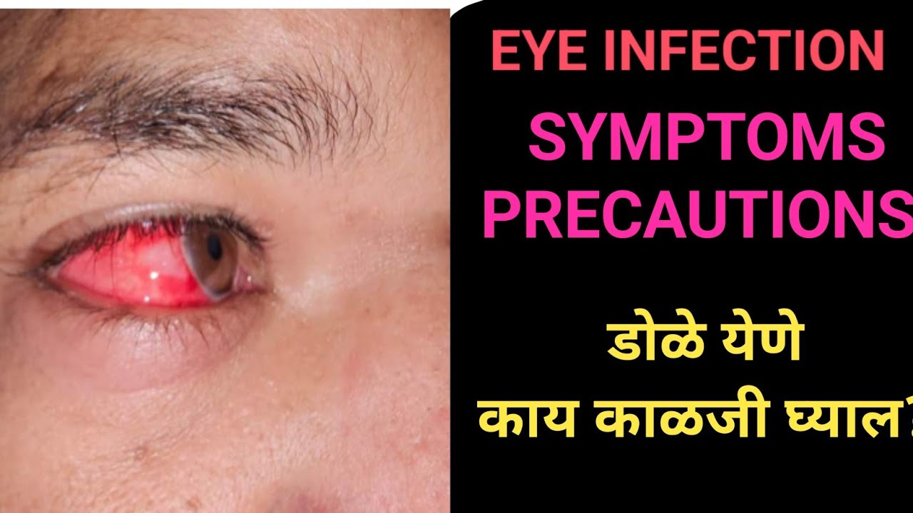 Eye infection|eye infection symptoms| treatment डोळे येणे काय काळजी ...
