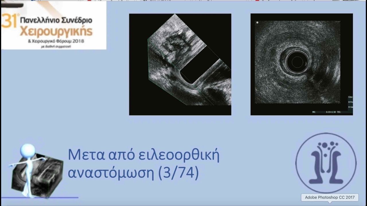 ΠΡΟΣΘΙΑ ΠΕΡΙΠΡΩΚΤΙΚΑ ΣΥΡΙΓΓΙΑ ΣΤΙΣ ΓΥΝΑΙΚΕΣ: ΑΚΡΟΒΑΤΩΝΤΑΣ ΣΕ ΤΕΝΤΩΜΕΝΟ ...
