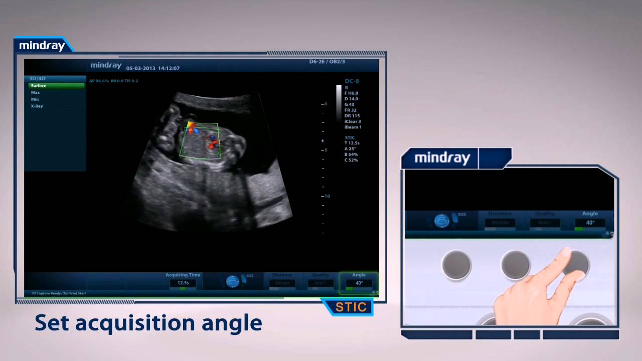 STIC Mindray - YouTube