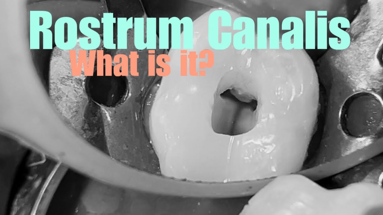 ROSTRUM CANALIS / CANALIUM . WHAT IS IT? AND WHAT IS IT FOR? - YouTube