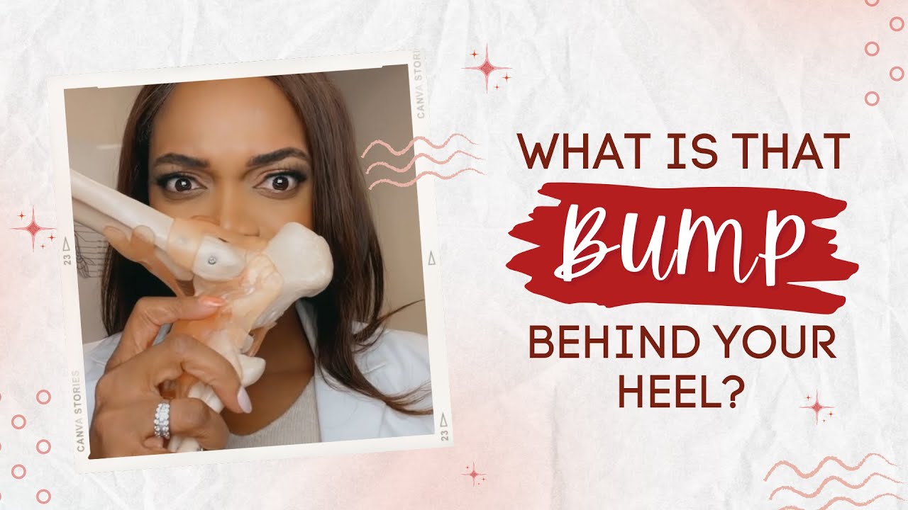 Haglund's Deformity: A Bony Bump Behind Your Heel #haglundsdeformity # ...