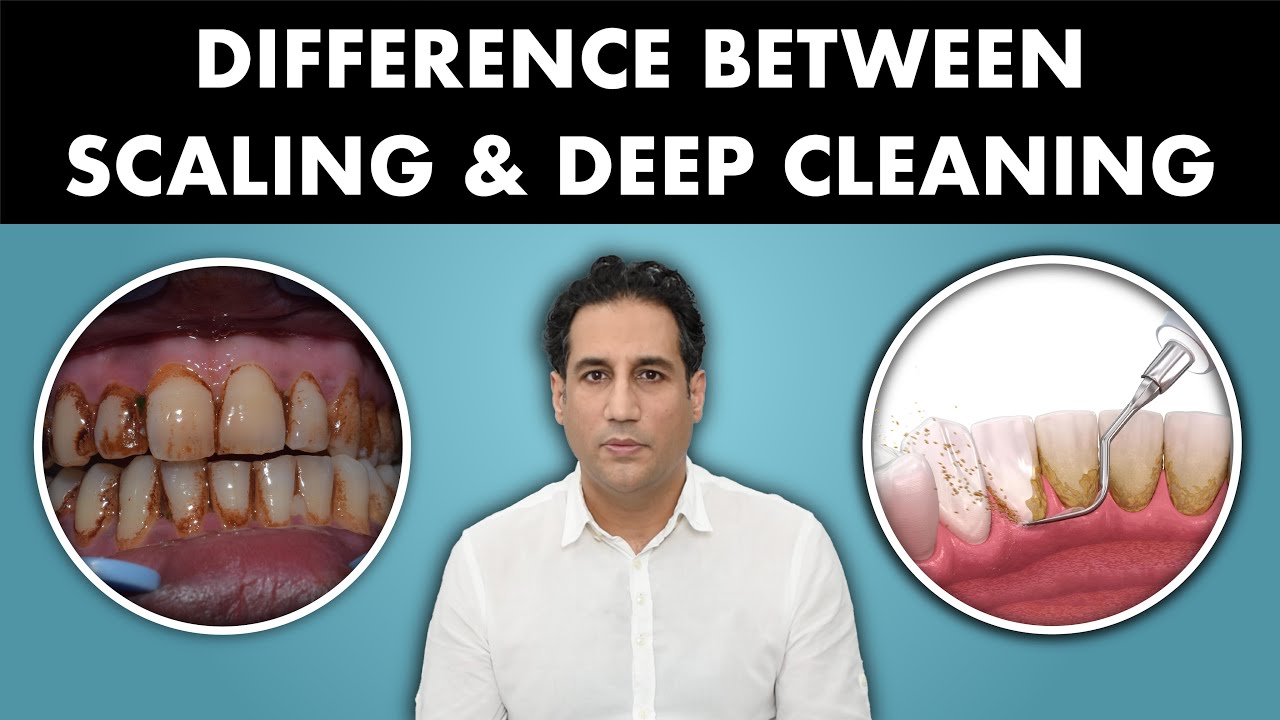 Difference Between Teeth Scaling & Deep Cleaning Procedure | What is ...