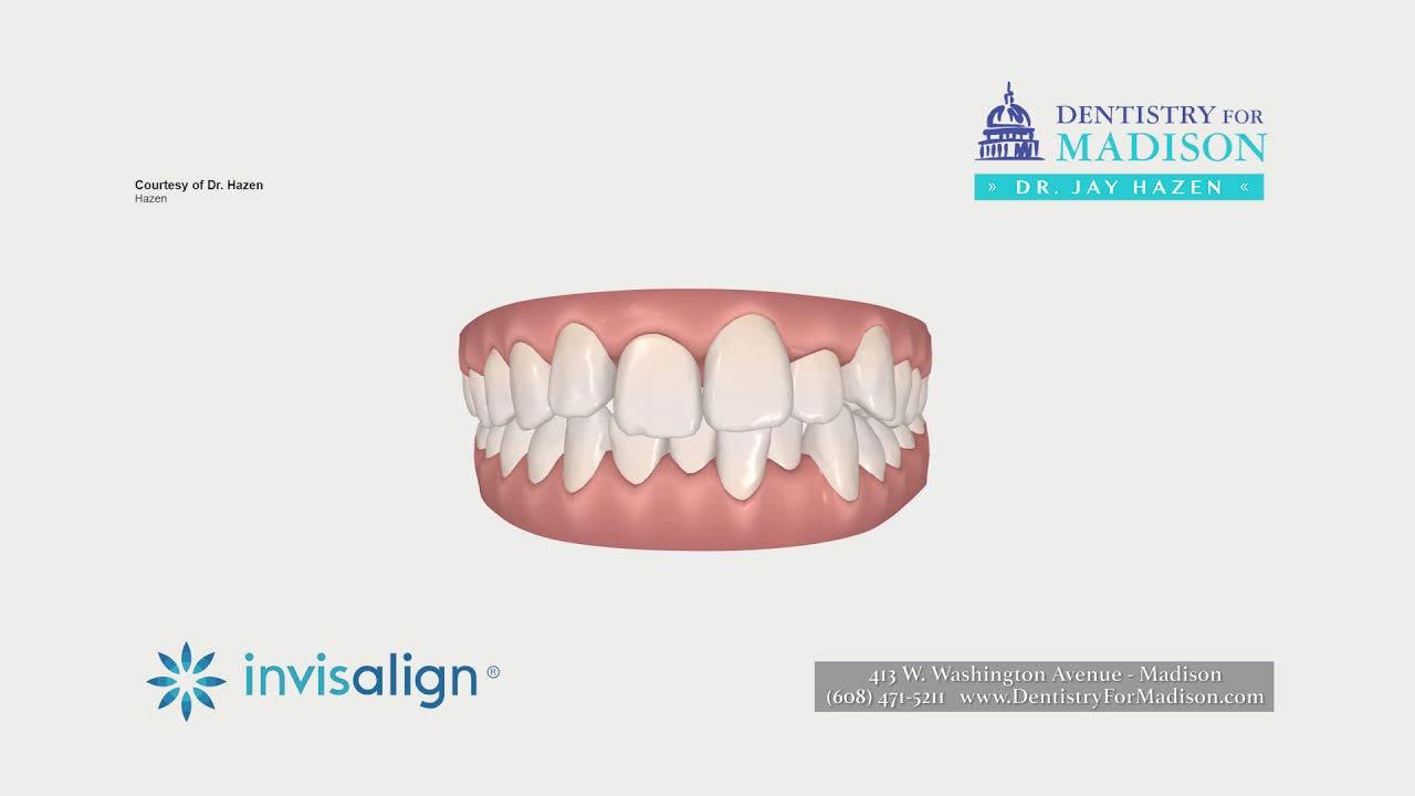 Dentistry for Madison Invisalign Commercial - YouTube