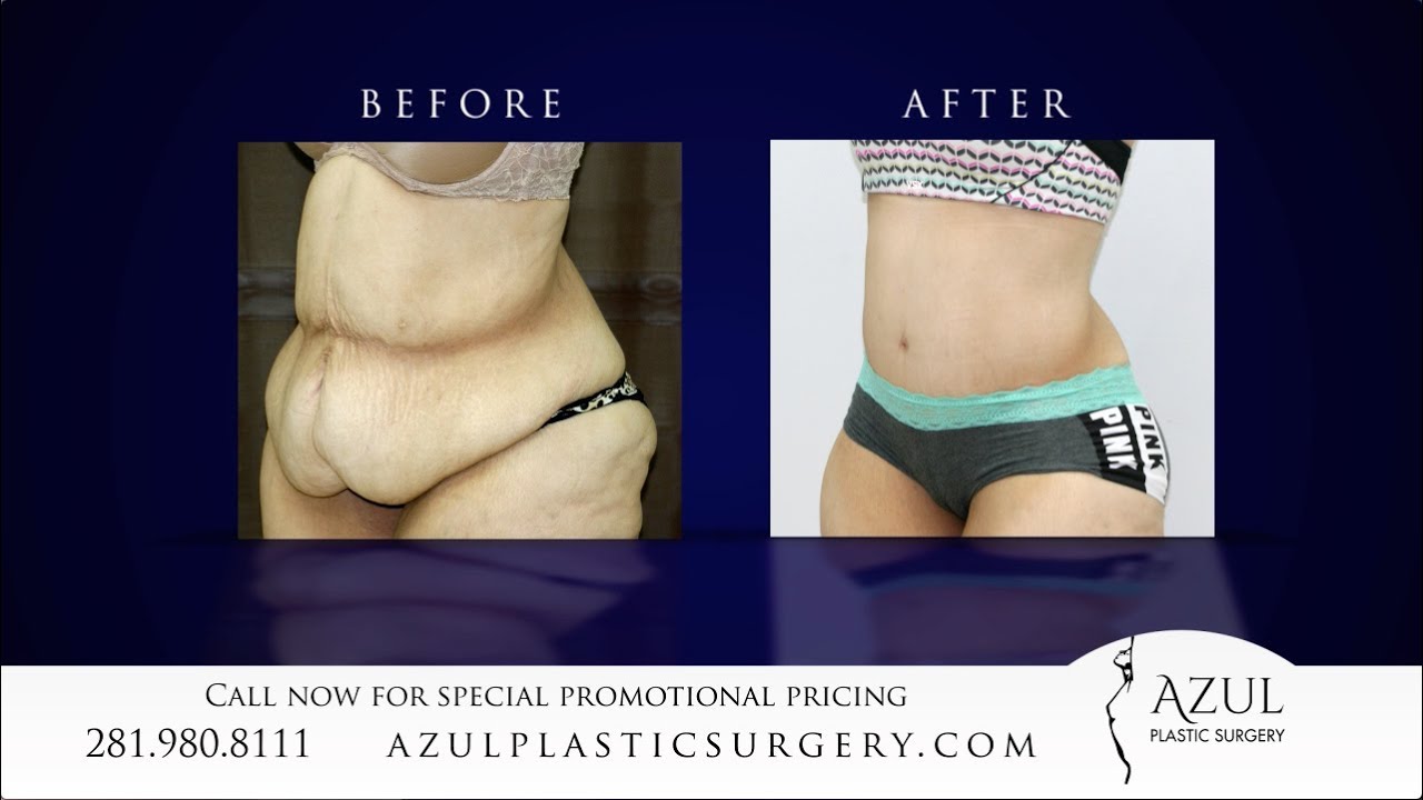 Houston Tummy Tuck after Weight Loss at Azul Plastic Surgery Sugar Land Woodlands TX - YouTube