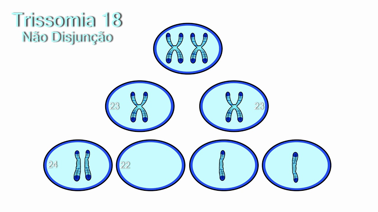 Síndrome de Edwards Trissomia do 18 - resumo - YouTube
